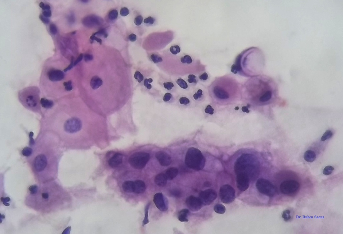 THE PERUVIAN CYTOPATHOLOGY CORNER: CITOLOGÍA CERVICAL: ADENOCARCINOMA ...
