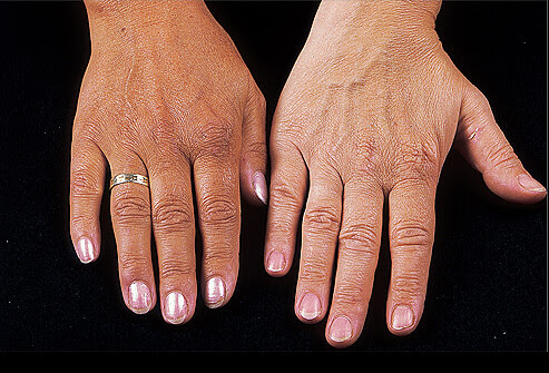 Medical Terms & Сlinical Сases : Addison's disease (Addison's syndrome)