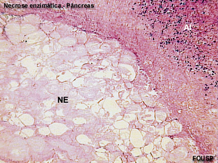 Necrose Gordurosa; Esteatonecrose