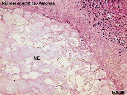 Conselhos da Nutrição: Necrose e seus tipos