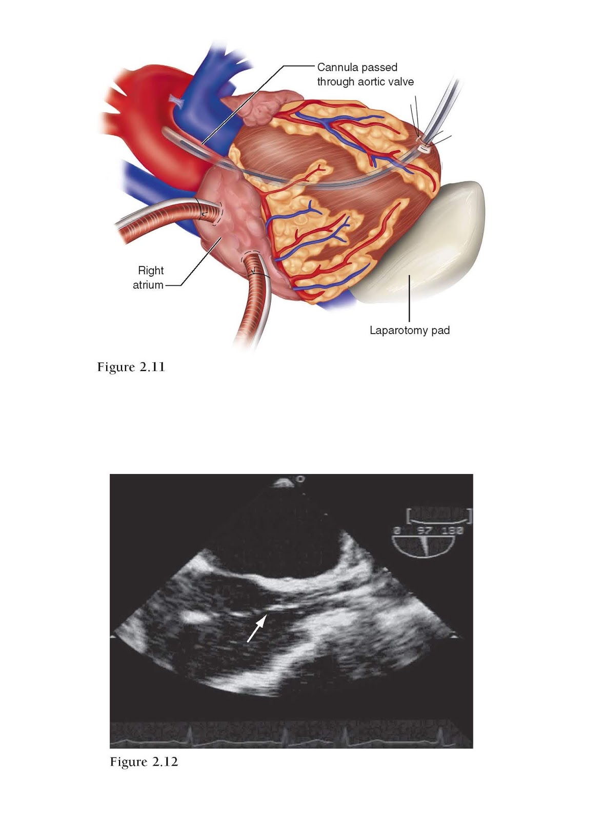 Arterial Cannulation - pediagenosis