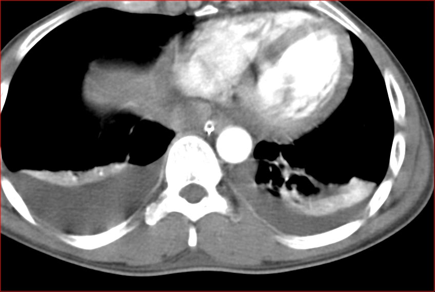 RADIOLOGY IMAGE SPOTTERS: Bilateral hemothorax