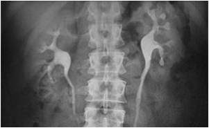 Radiografer Muda: TEKNIK RADIOGRAFI BNO IVP