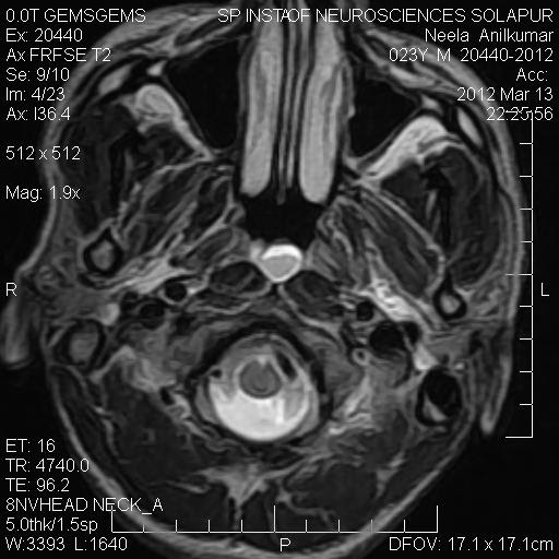 Dr Balaji Anvekar FRCR: Thornwaldt's cyst MRI