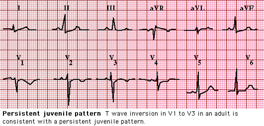 IPHREHAB: IPHREHAB : HOW TO READ ECG