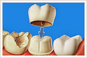 Muito bom esse café !: Resumão de Prótese Fixa