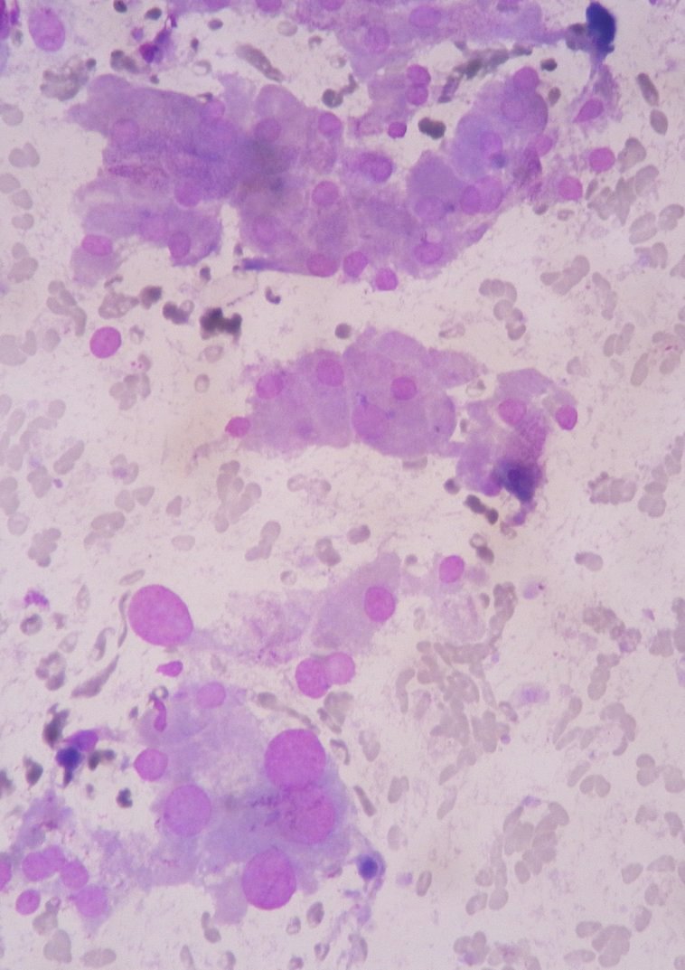 into the roots: Some thyroid lesions