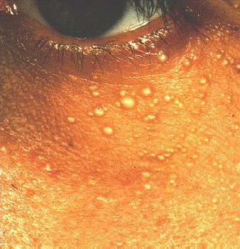 SkinStation: HOW TO GET RID OF MILIA