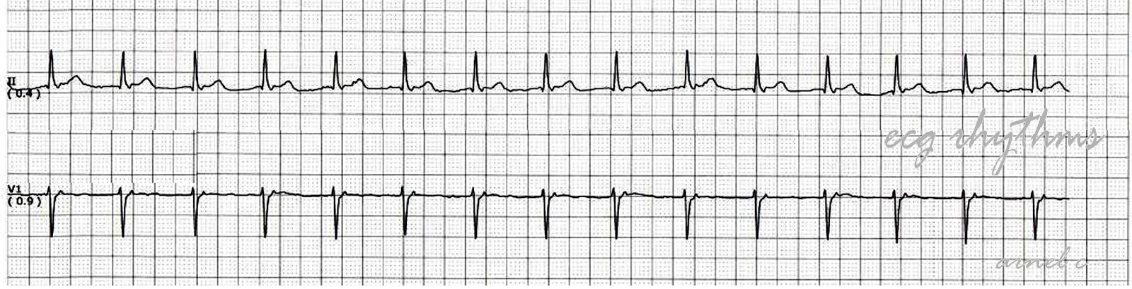 ECG Rhythms: Isorhythmic AV dissociation