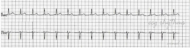 ECG Rhythms: Isorhythmic AV dissociation