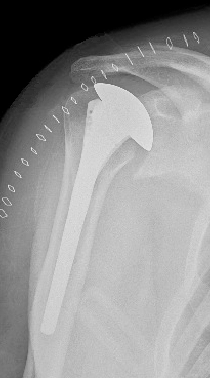 Shoulder Arthritis / Rotator Cuff Tears / Shoulder Pain ...