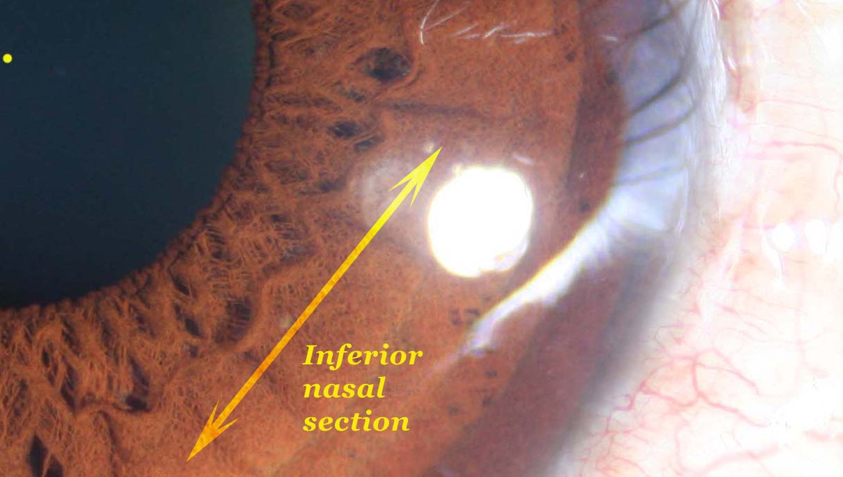 Modern & Multidimensional Iridology: Misshapen Collarette - Rx - (emran ...