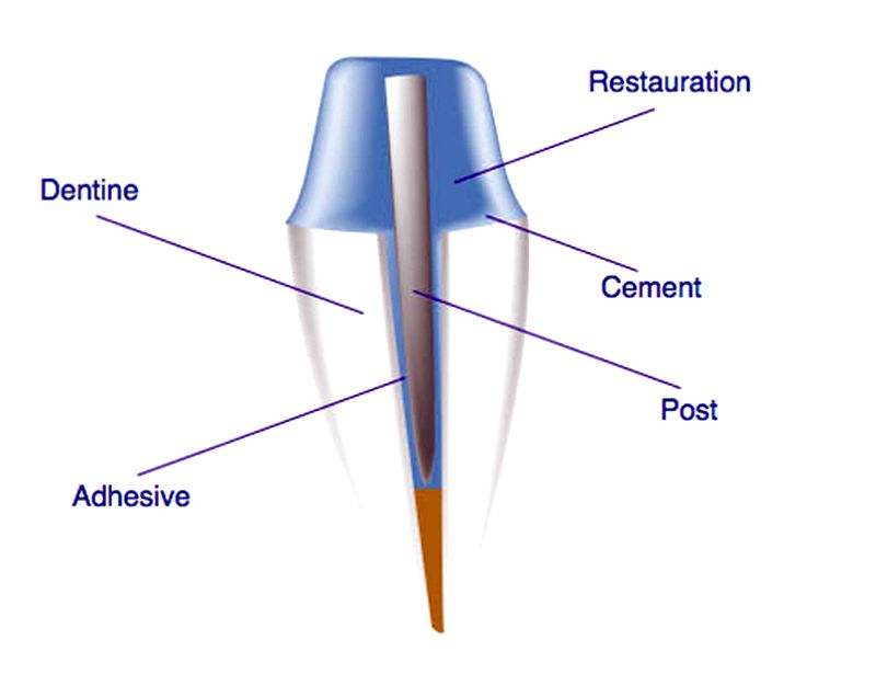 PDF: FIBER POSTS: Intra-radicular dentin treatments and retention of ...
