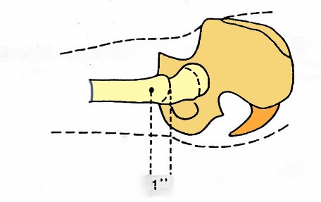 Skeletal Traction: Common sites