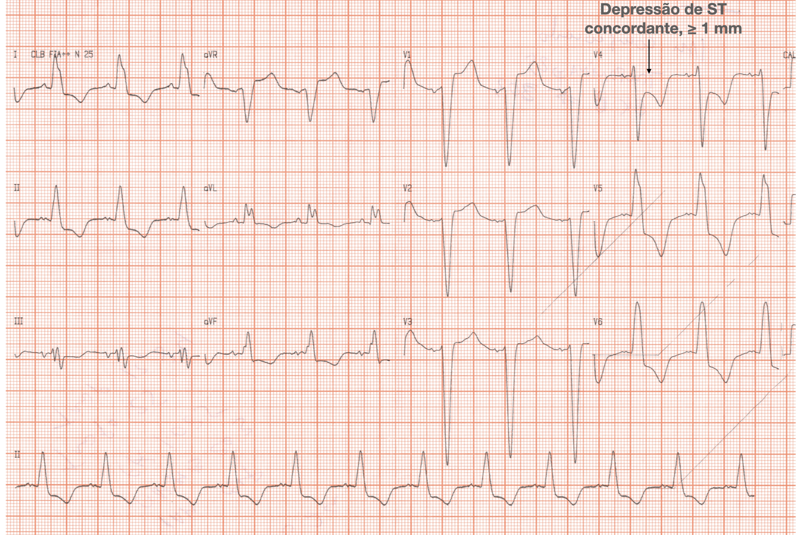 Blog de Eletrocardiografia: ATUALIZAÇÃO: ALGORITMO DE BARCELONA PARA O ...