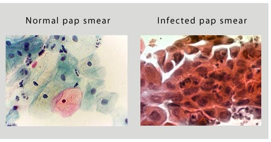 Medical Outlines: Abnormal Pap Smear and Cervical Cancer
