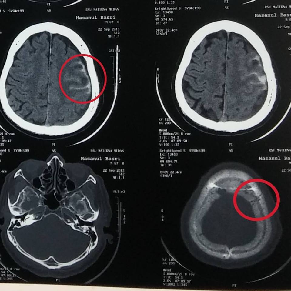 Dari RS Materna, Berikut Hasil CT Scan Bagian Kepala Abu Mudi - Dayah ...