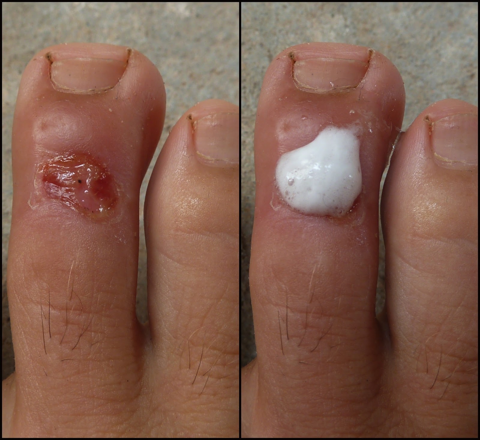 on the lam in southeast asia: Spider bites, keloid injections and ...