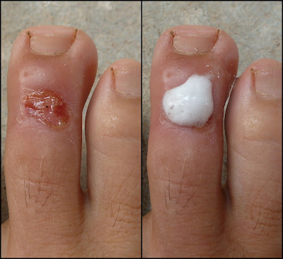 on the lam in southeast asia: Spider bites, keloid injections and ...