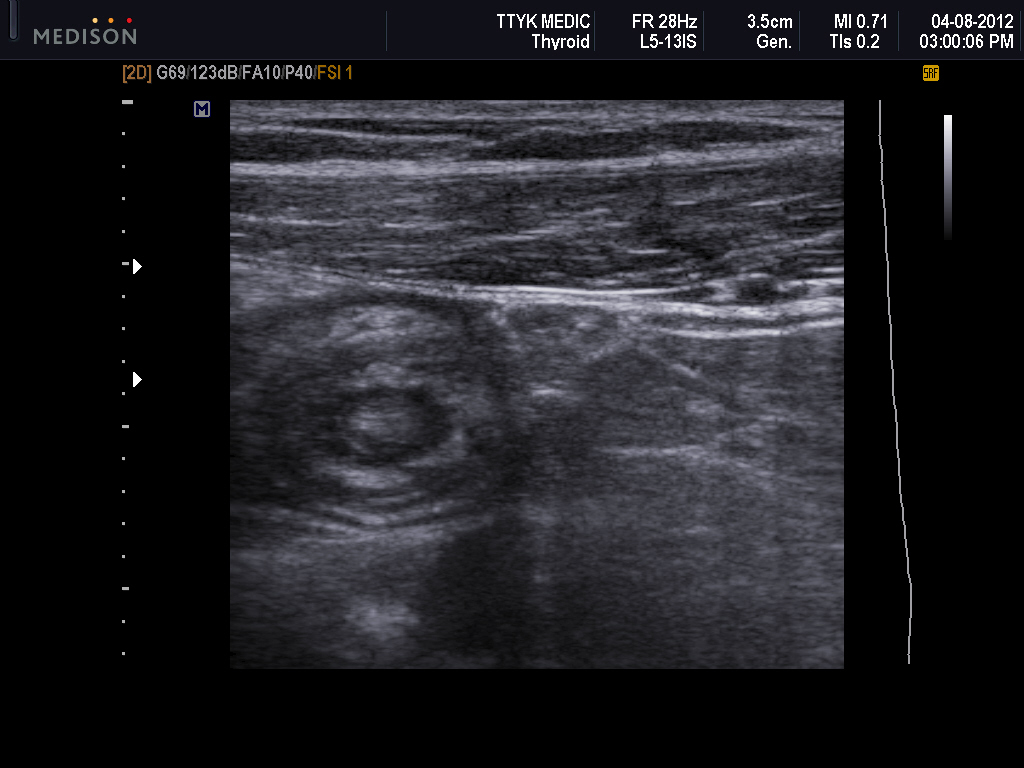 VIETNAMESE MEDIC ULTRASOUND: CASE 137: APPENDIX TUMOR, Dr PHAN THANH ...