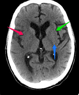 MedicoNotebook: Stroke