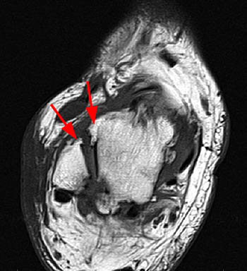 MRI Musculo-Skeletal Section: Accessory anterior inferior tibio-fibular ...