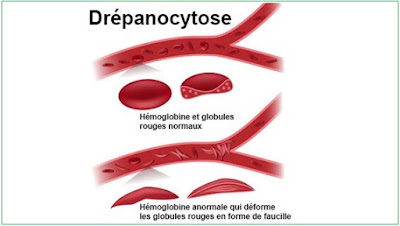 Drépanocytose Définition , Causes et Symptômes | Bio faculté