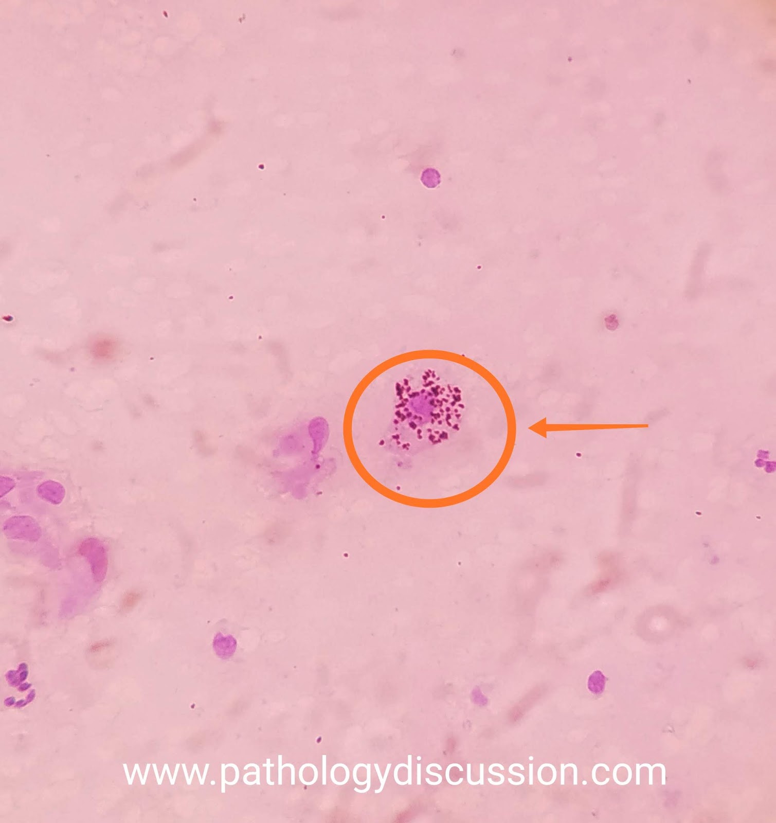 Pigments: Melanin,lipofuscin,hemosiderin,hemozion,bilirubin etc