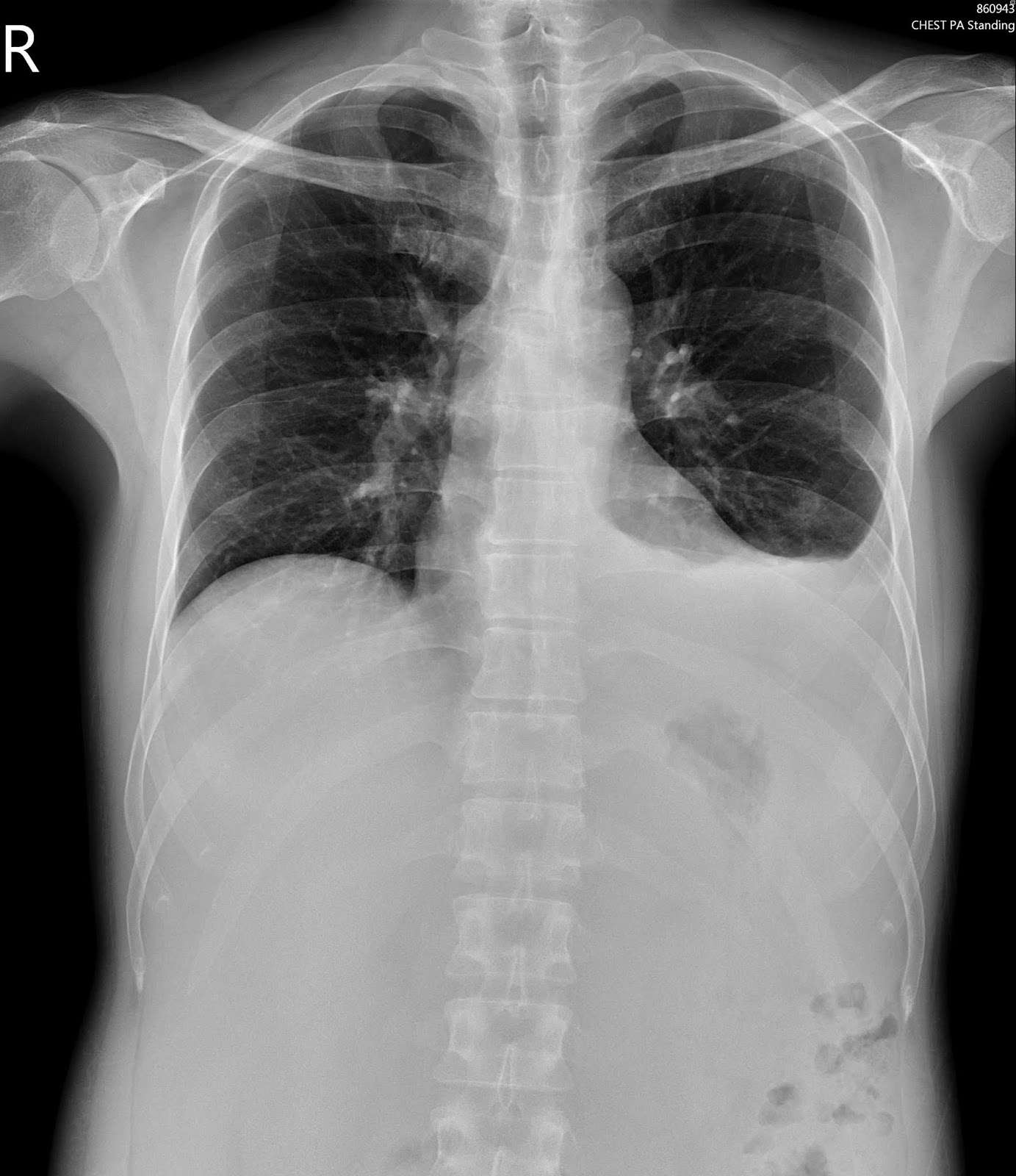 Meniscus Sign Pleural Effusion | Images and Photos finder
