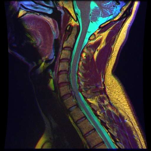 Nevit's blog: Color MRI of Cervical vertebrae