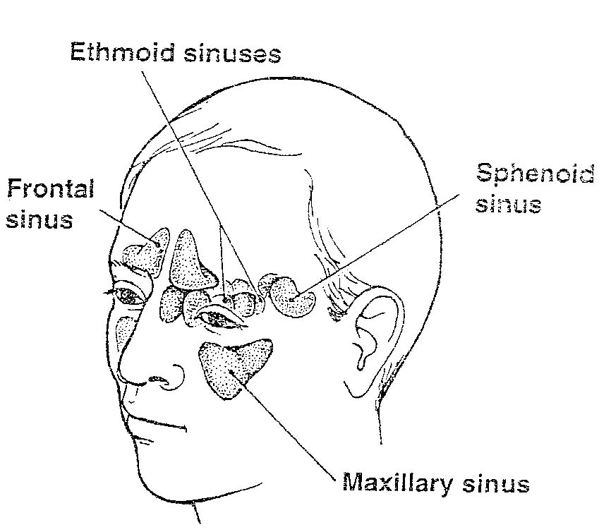 DINAR'S: SINUSITIS: GEJALA DAN PENANGGULANGANNYA