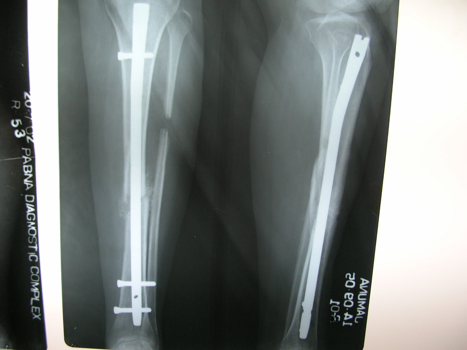 X-rays and Slides: Intramedullary in tibis with fibulectomy