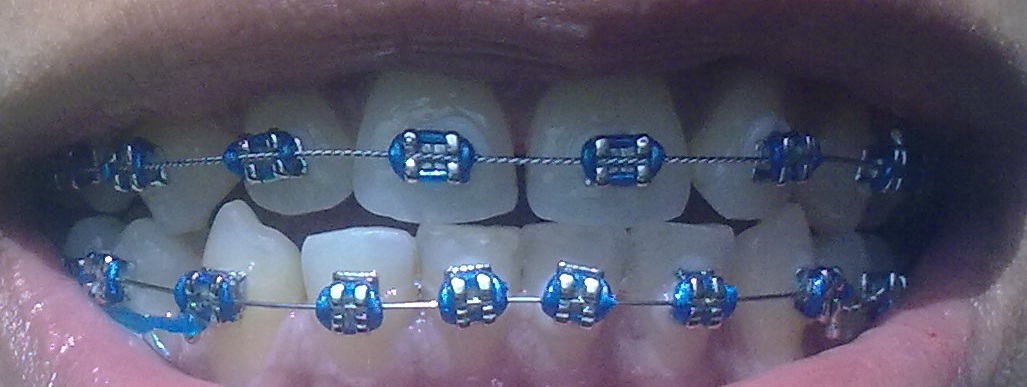 Mr Braces 7Eleven: Tukar Getah Braces - Biru