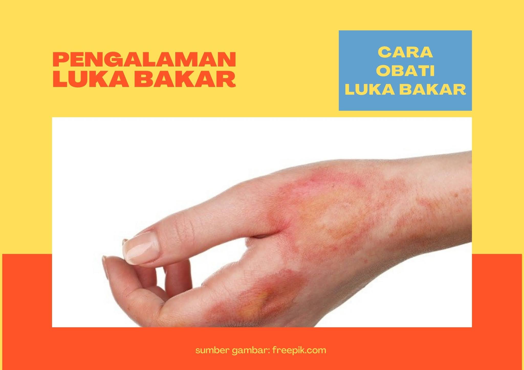 Pengalaman Luka Bakar, Lebih Sakit Dibanding Melahirkan Anak! | Curhat Si Ambu
