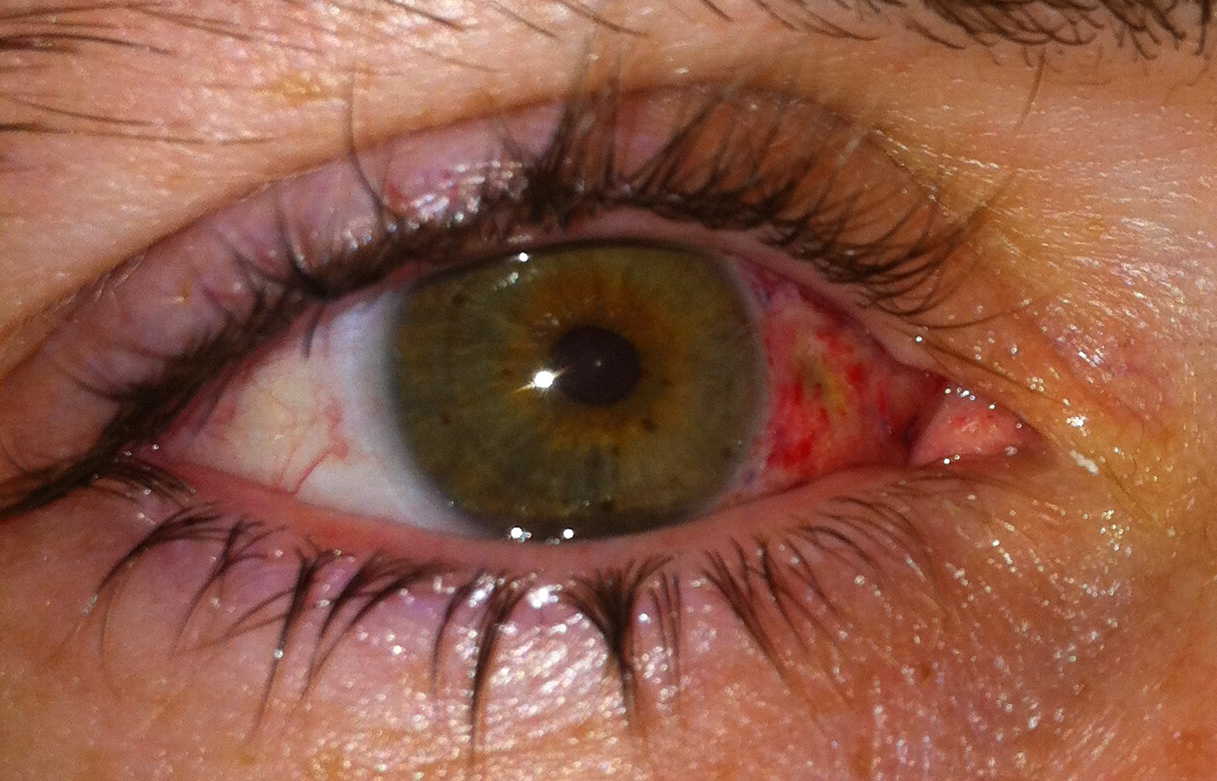 Creighton Chronicles: Pterygium Removal