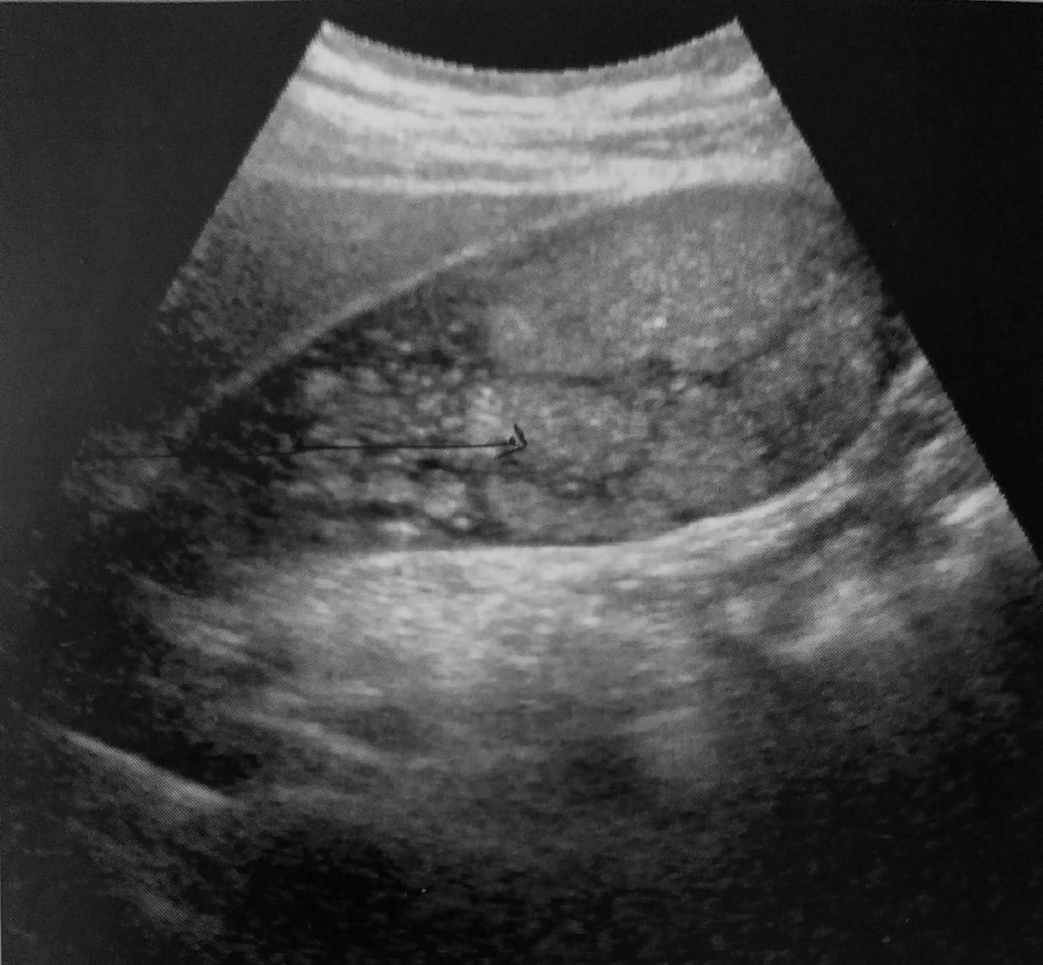 What is Biliary sludge? - Health and Nutrition