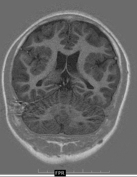 Polymicrogyria-Teaching Points - Sumer's Radiology Blog