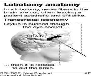 WORLD INFO: Lobotomy is a neurosurgical procedure