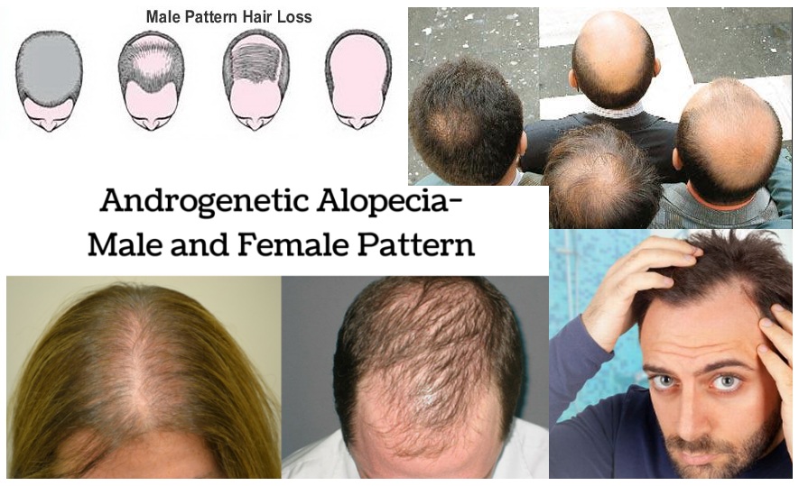 Male Androgenic Hair Loss