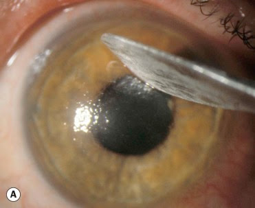 CORNEAL SCRAPING AND CAUTERIZATION OF ULCERS