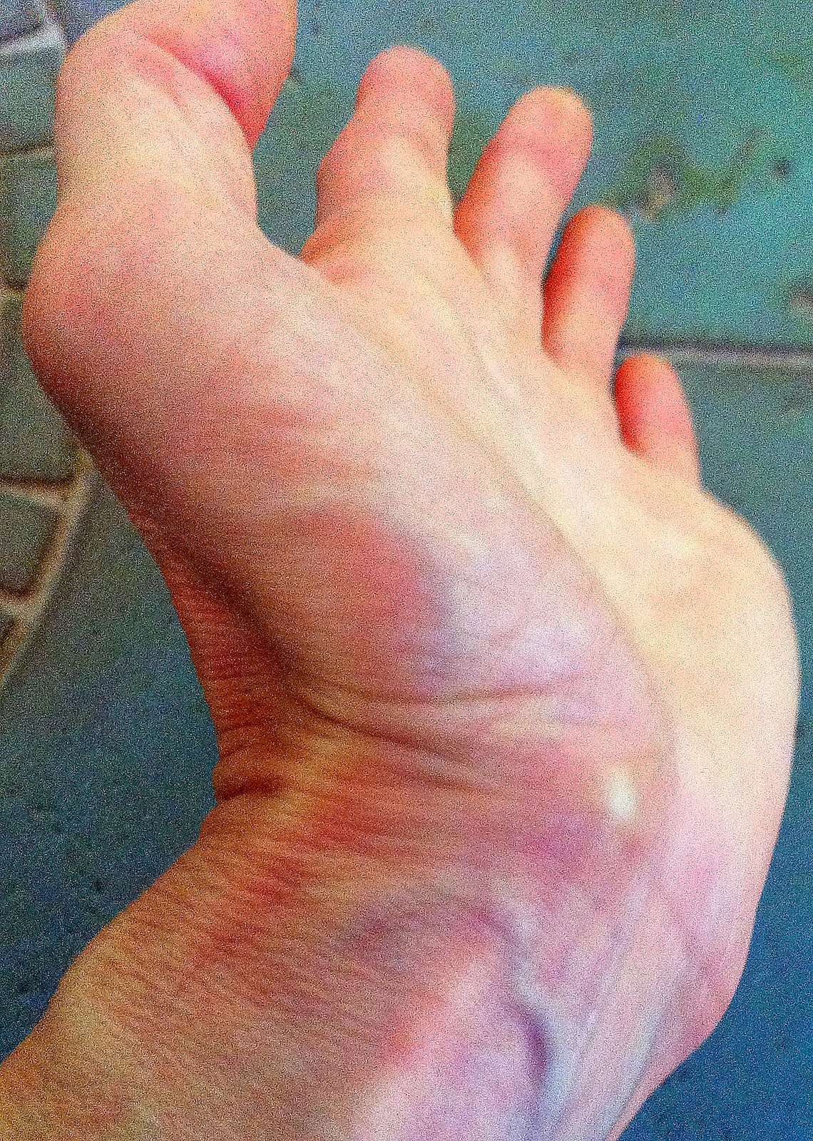 Summit Medical Group Ganglion Cyst Removal Ganglionec Vrogue co