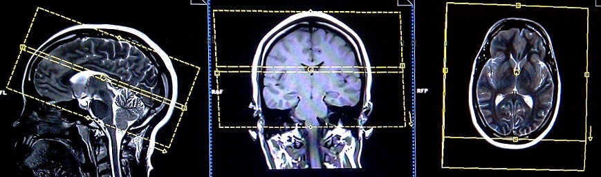 MRI Brain Planning ~ King's of Radiology