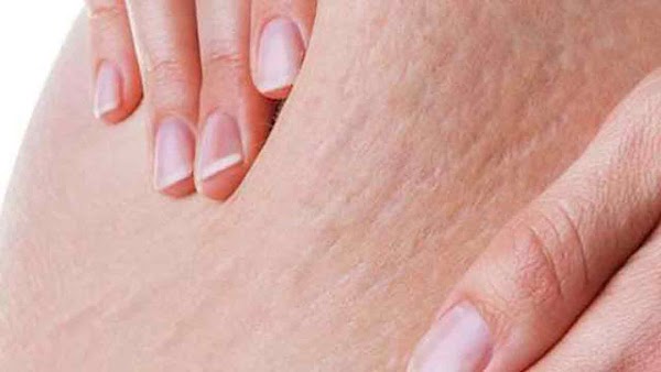 5 Cara Alami Hilangkan Selulit | Kang Sodikin Blog