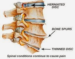 Medical Treatment Pictures-for Better Understanding: Back Surgery ...