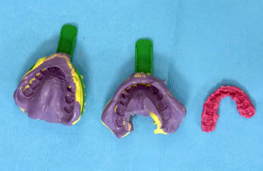 DENTAL IMPRESSION: The Two-Step Impression Technique