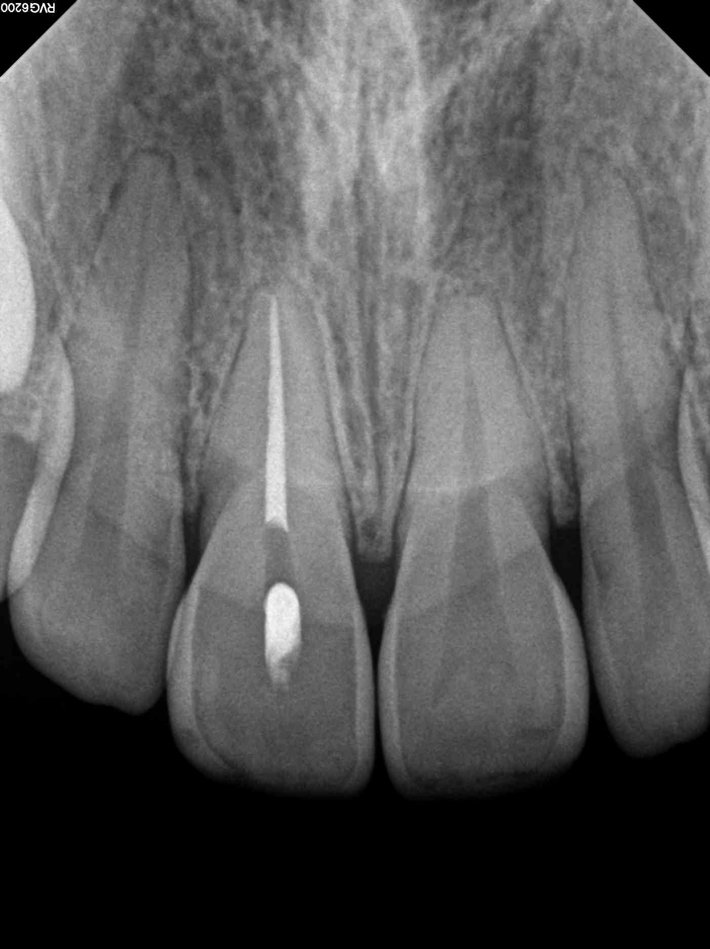 TRATAMIENTO DE CONDUCTOS: 1.1 calcificado. Blanqueamiento interno