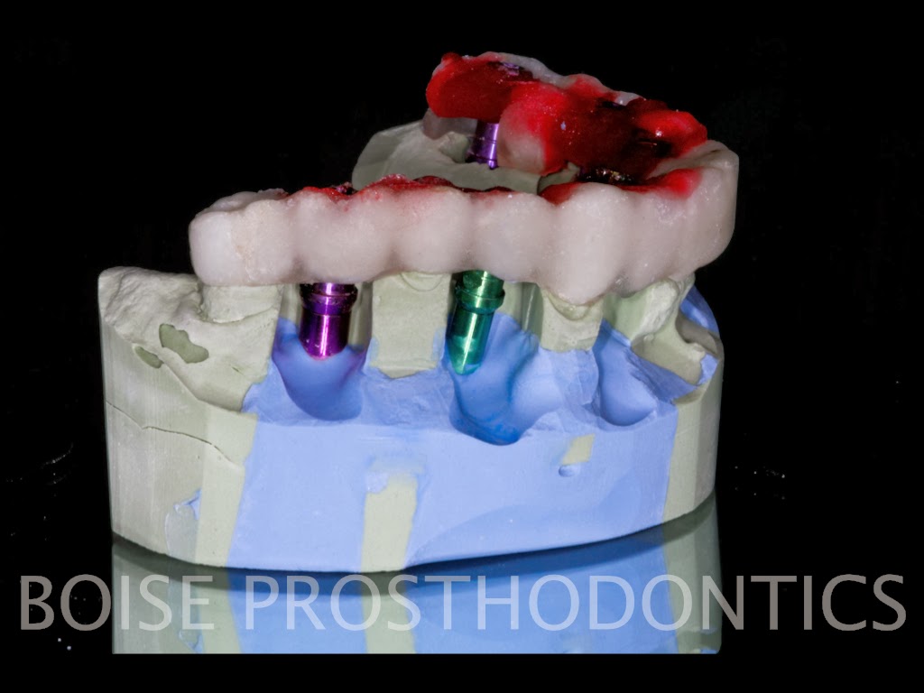 Boise Idaho Prosthodontics: Maxillary Implant Rehab Provisional, Index ...