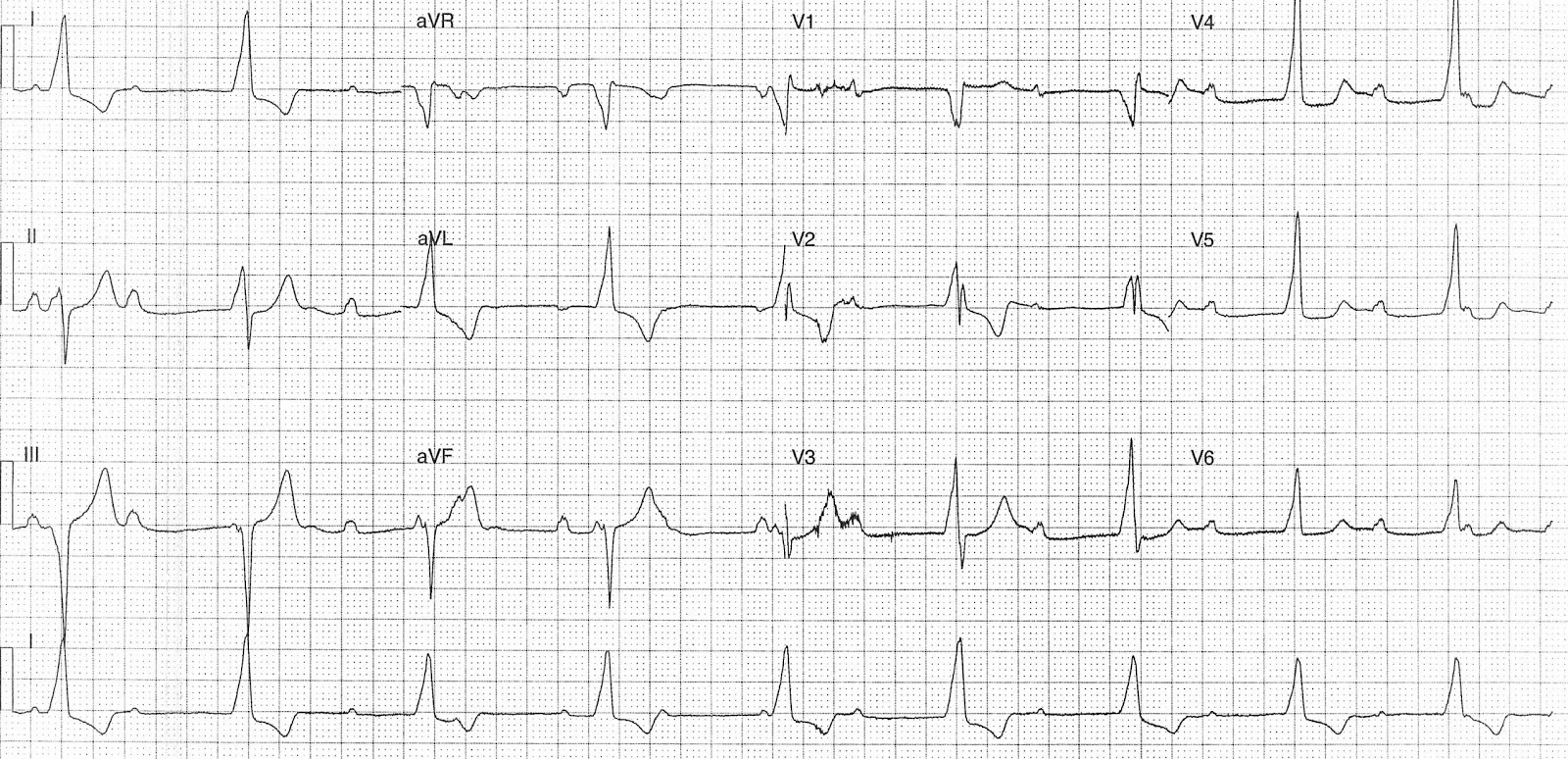 ECG of the Week: ECG of the Week - 23rd October 2017 - Interpretation