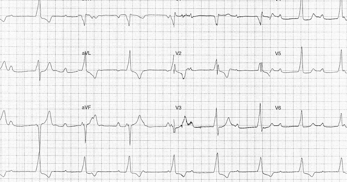 ECG of the Week: ECG of the Week - 23rd October 2017 - Interpretation