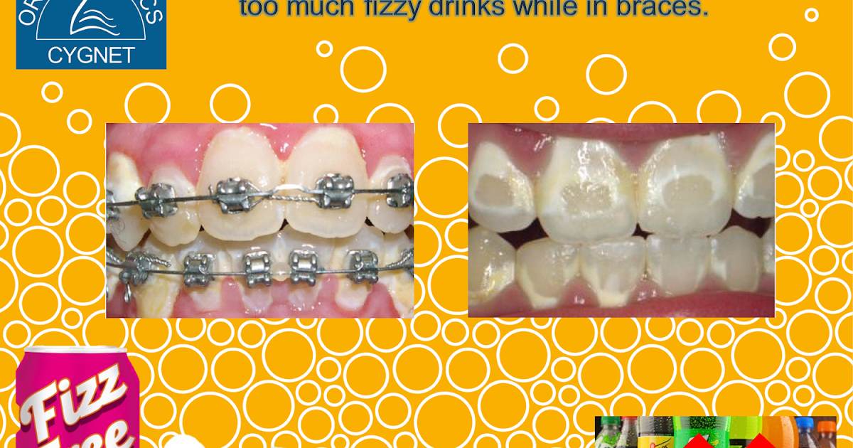 Tooth Decalcification